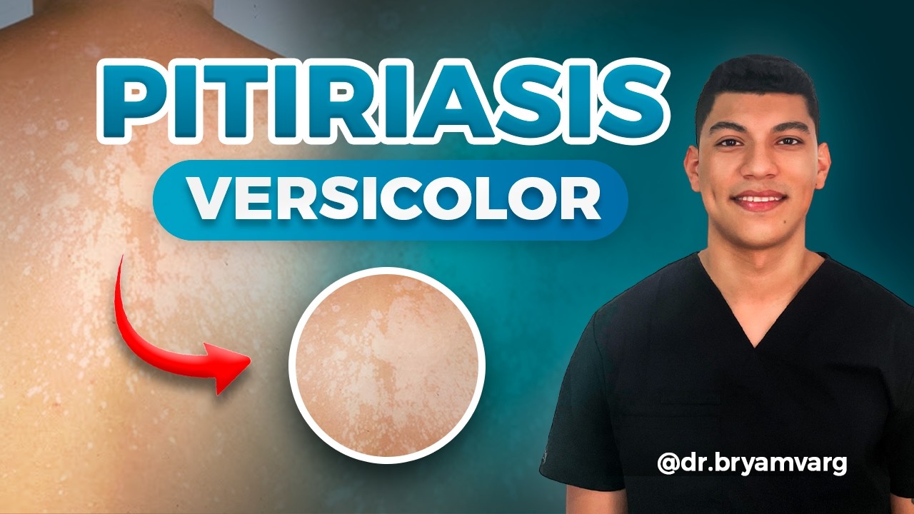 PITIRIASIS Versicolor (Manchas blancas) | Diagnóstico y Tratamiento ...