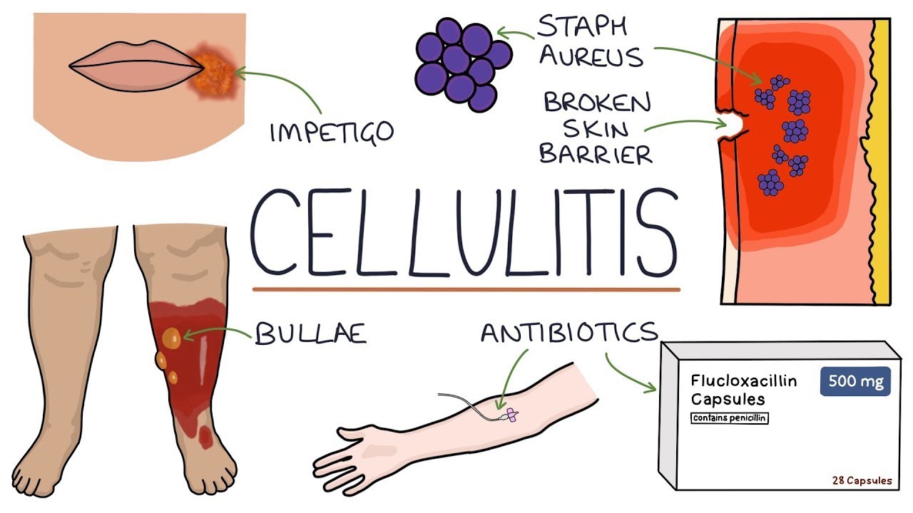 Cellulitis Frequency Healing - YouTube