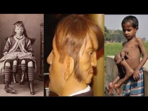 TOP 5 PEOPLE WITH EXTRA BODY PARTS | #truestory #documentary #story # ...