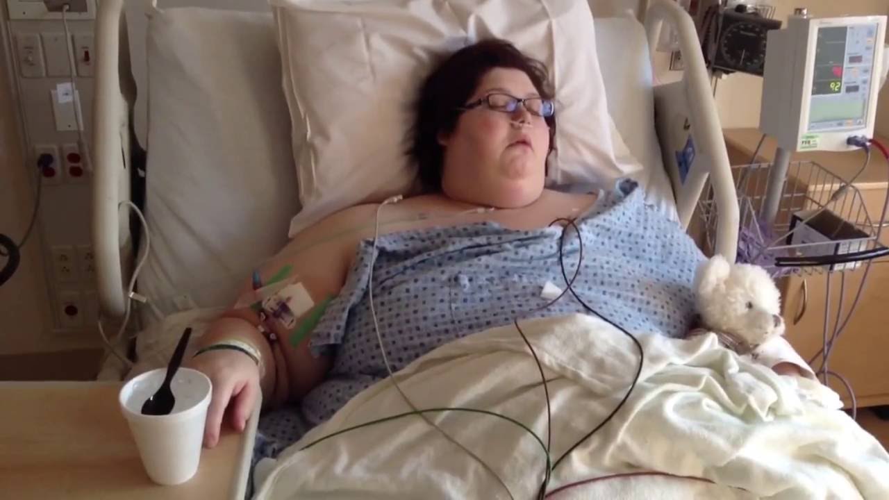 3 Years Post-op Gastric Bypass RNY WLS 523 pounds to 315 - YouTube