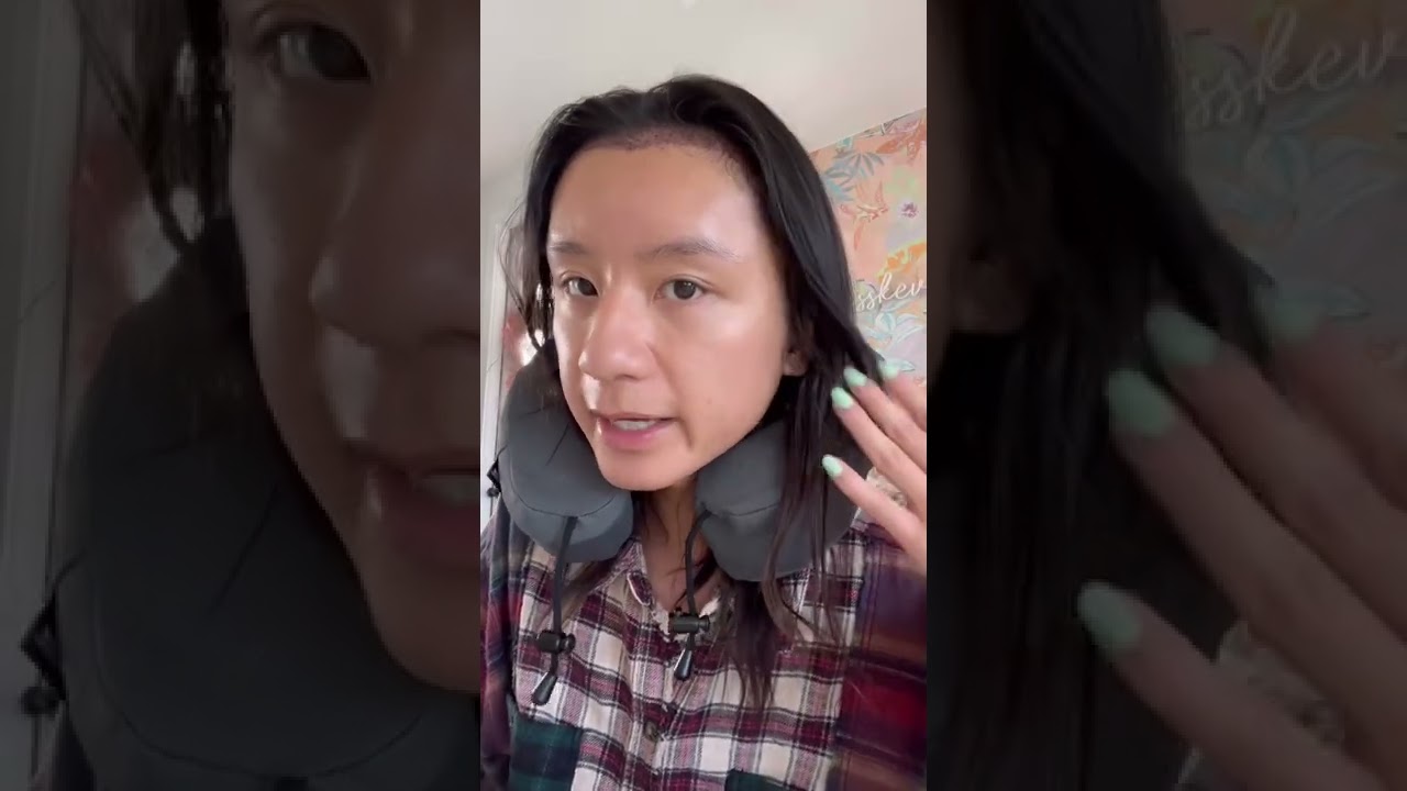 Day 2 Of My Hair Transplant Youtube
