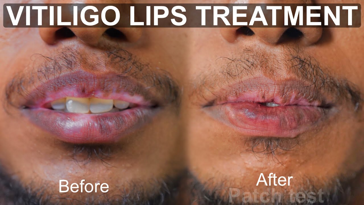One step solution for vitiligo lips | Organic process | Machu tattoos ...