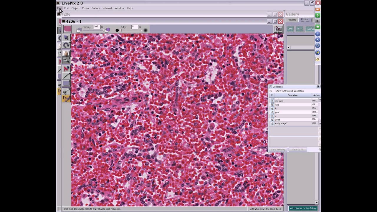 Medical School Pathology, 2013 Season, Session #55: Hem-Lab-II and Lung ...