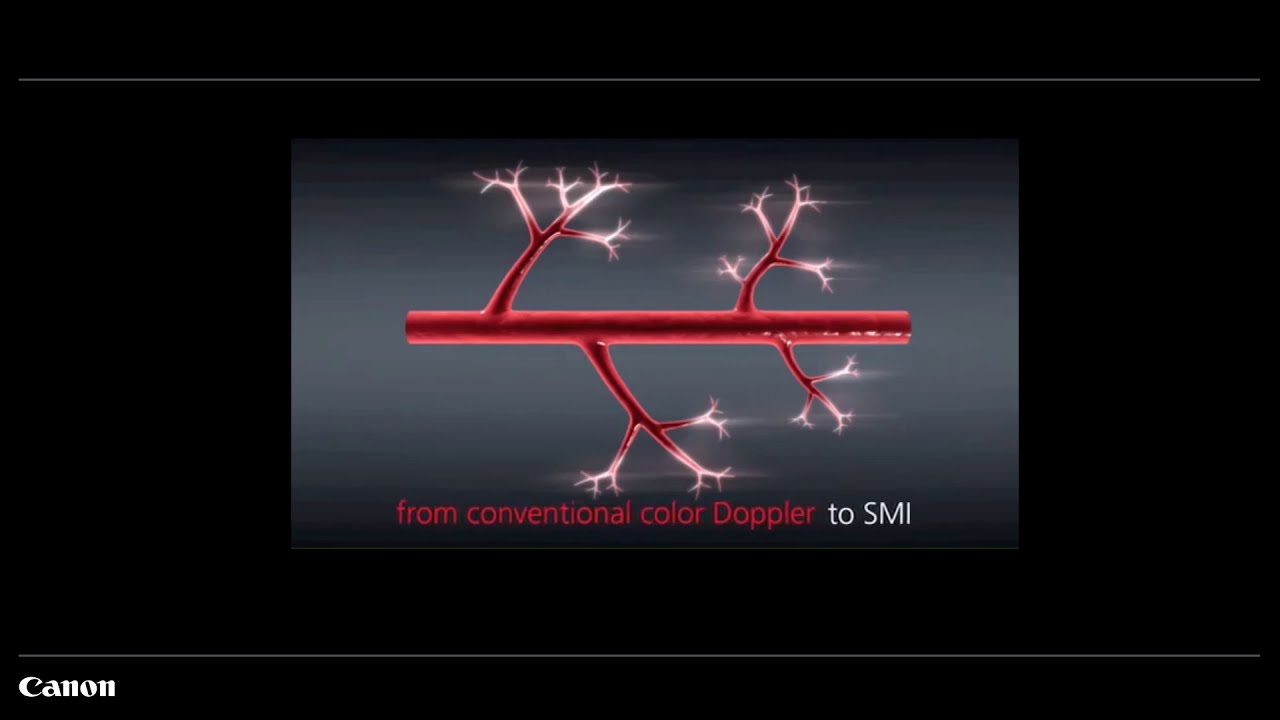 Where would you use Superb Micro-vascular Imaging (SMI)? - YouTube