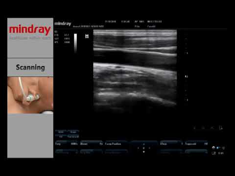 Mindray M7 - YouTube