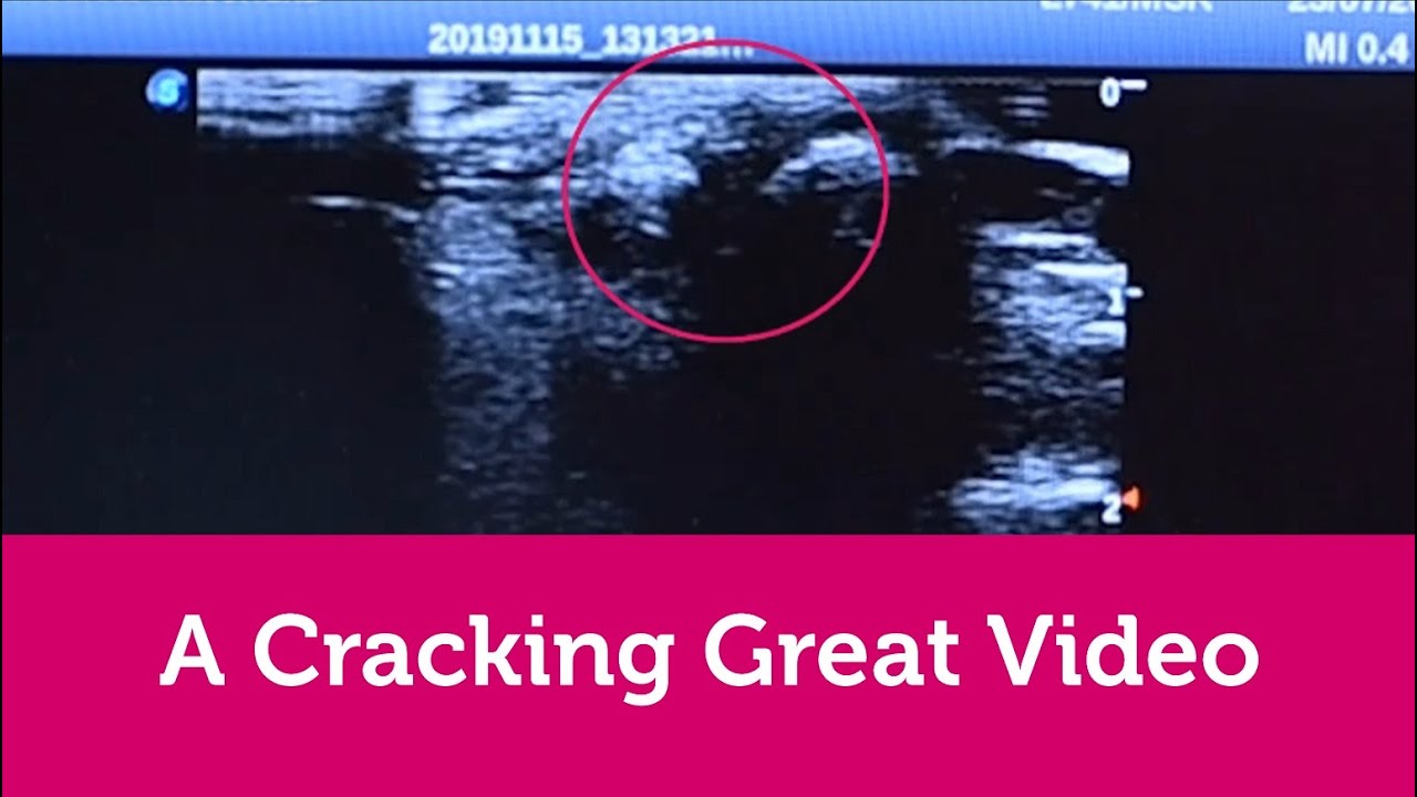 What happens when you crack your knuckles? - YouTube