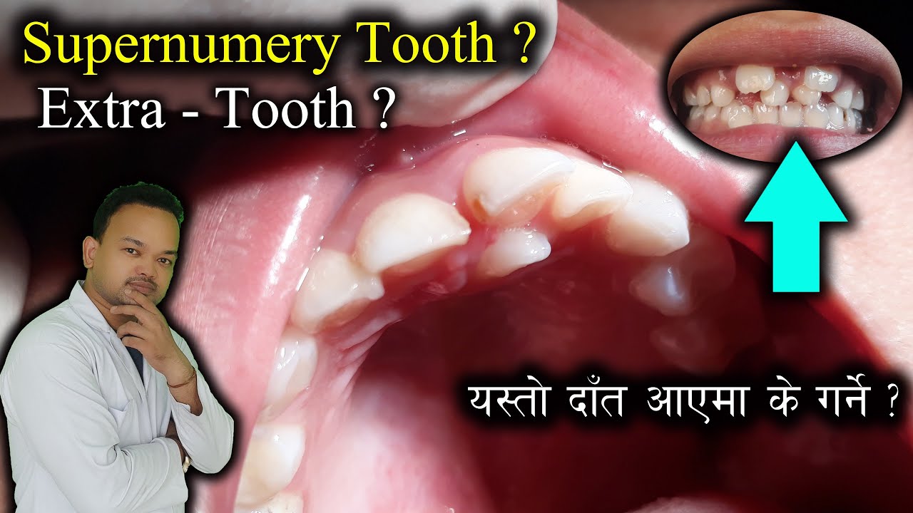 Supernumery Teeth/Mesiodense/Extra/Additional Teeth management ...