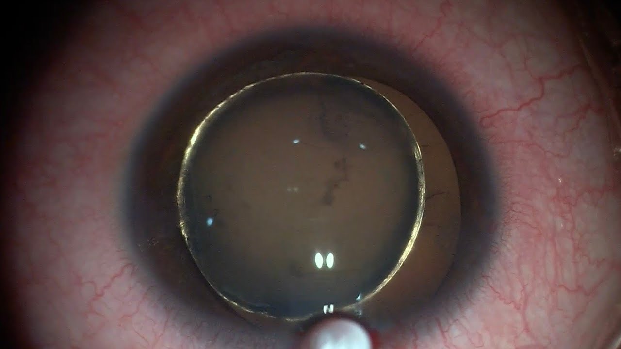 MicroSpheroPhakia 《Ectopia lentis 》 (2 cases with different management ...