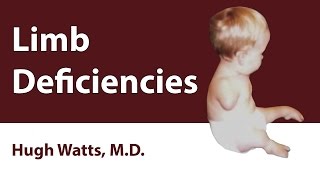 Congenital Limb Deficiency