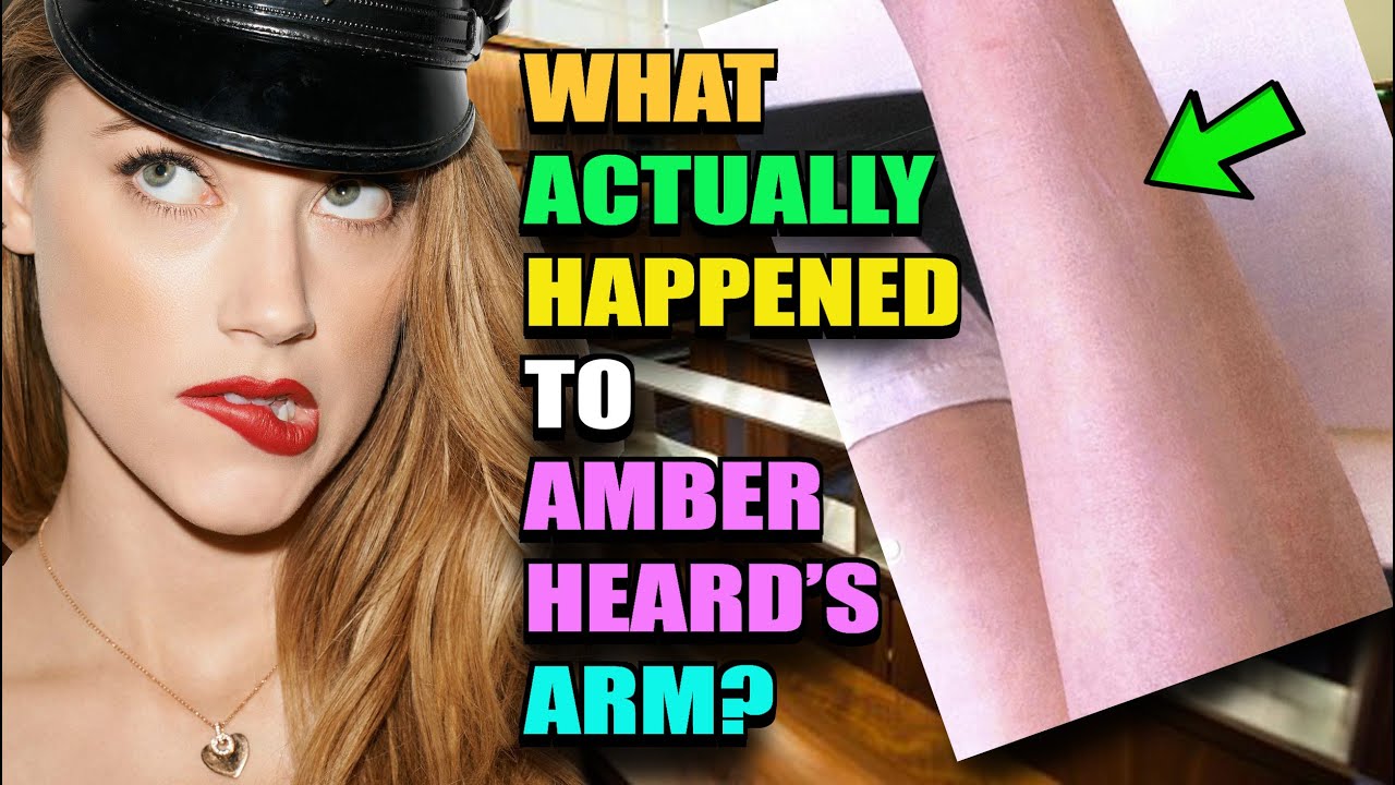 What Actually Happened to Amber Heard's Arm? - YouTube