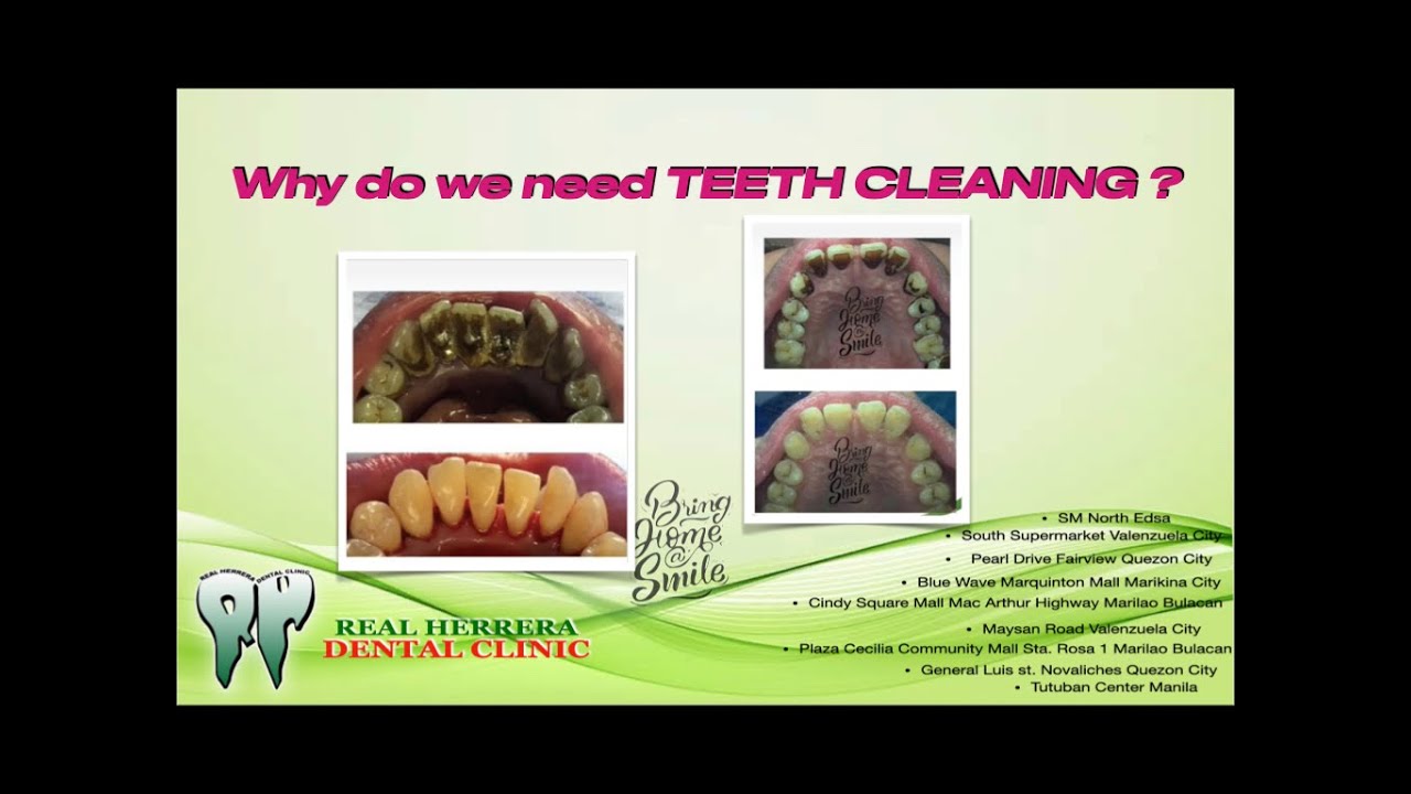 Oral Prophylaxis or Teeth Cleaning - YouTube