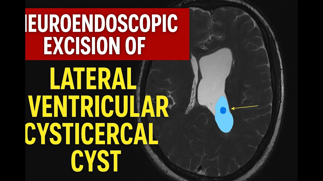 Neuroendoscopic excision of a lateral ventricular cysticercal cyst # ...