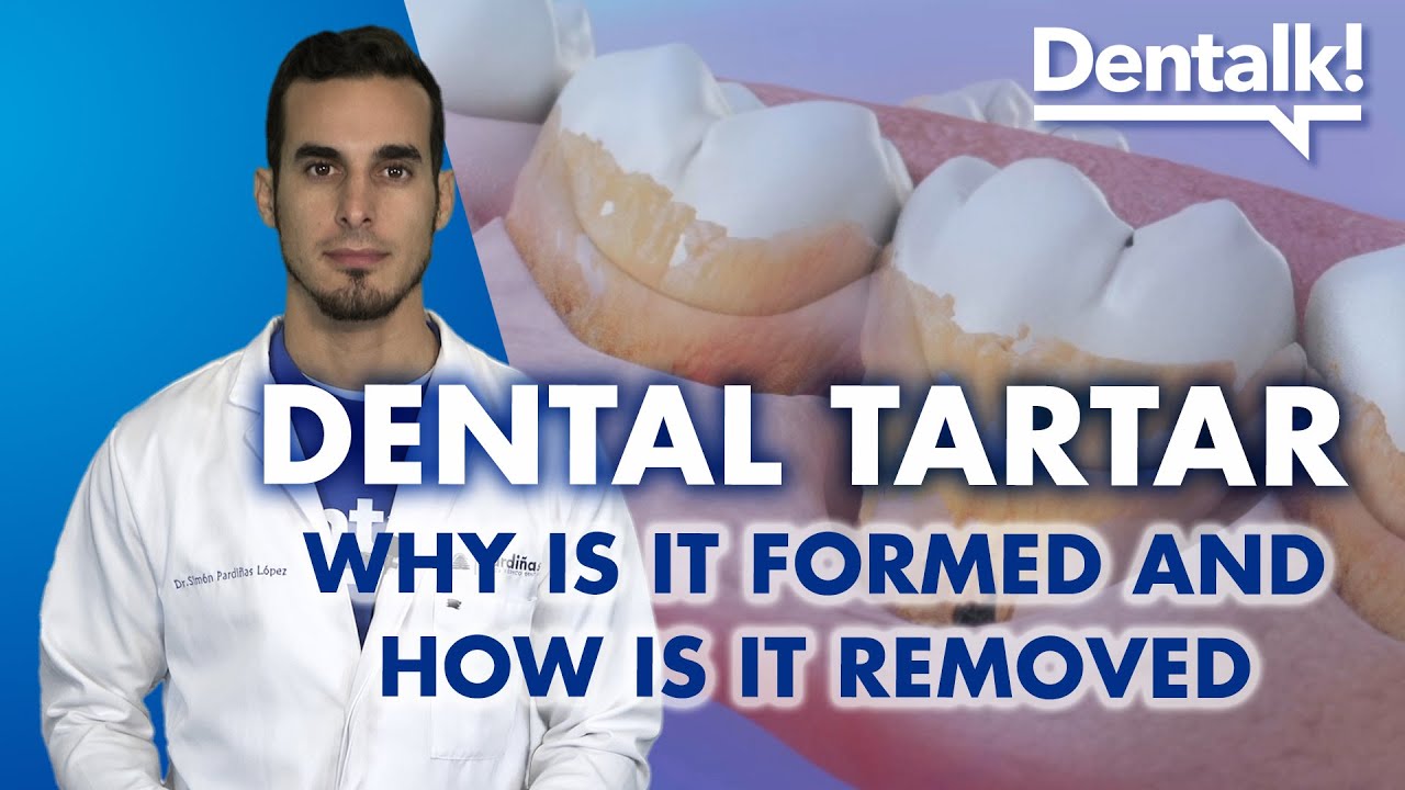 TARTAR from teeth - Causes, prevention and how to REMOVE dental PLAQUE ...