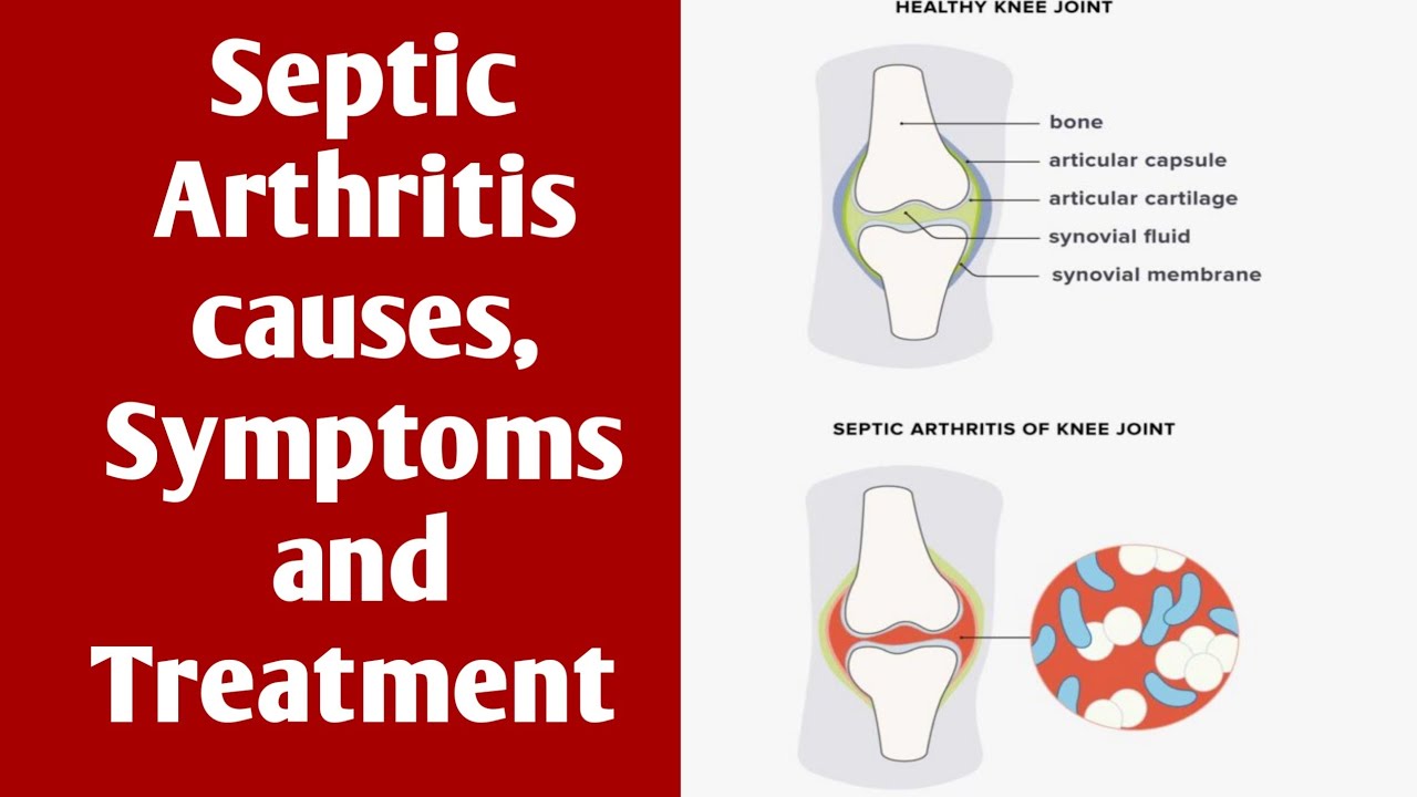 Septic Arthritis - Causes, Symptoms, Precautions and Treatment | By Dr ...