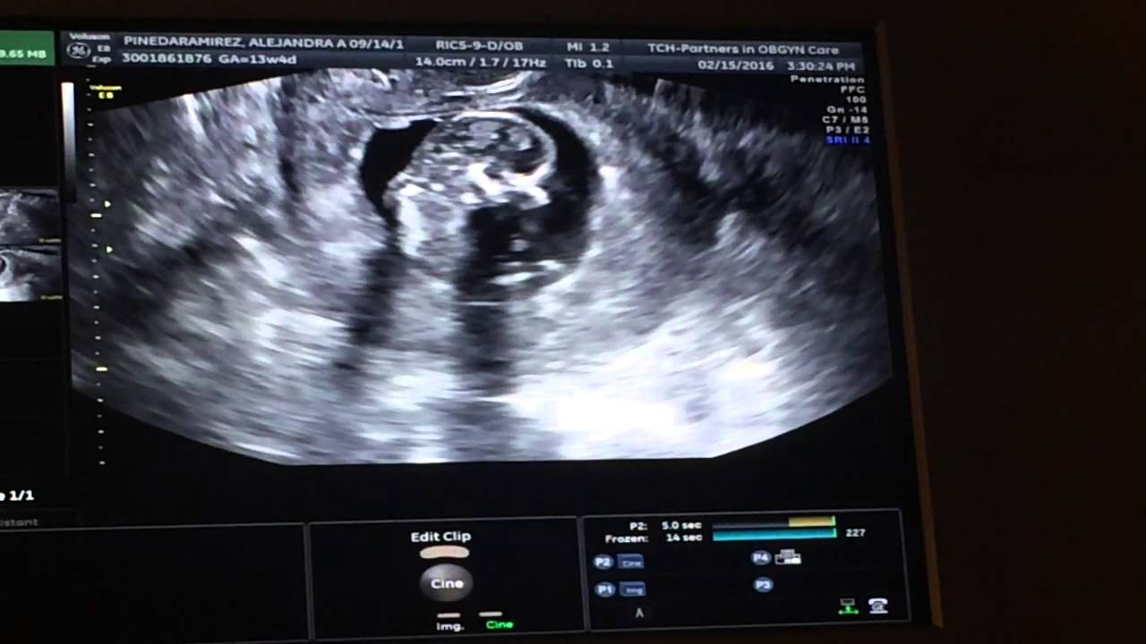 13 weeks 4 days ultrasound - YouTube