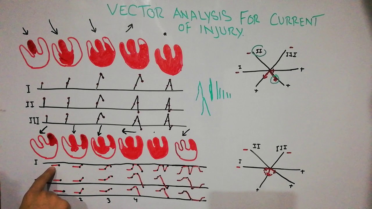 CVS physiology 39. Vectorial analysis for current of injury. - YouTube