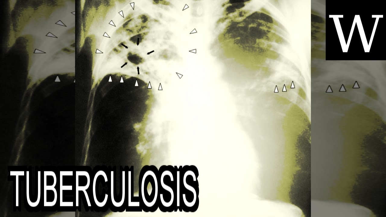 TUBERCULOSIS - Documentary - YouTube
