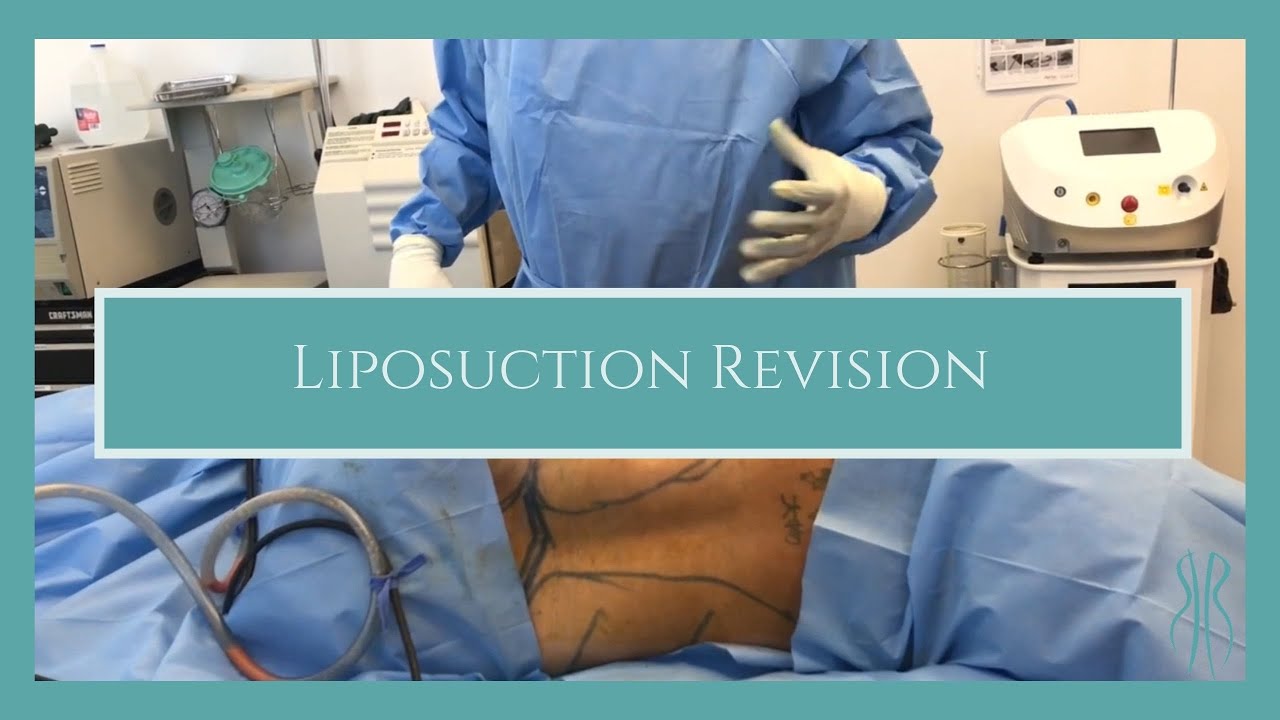 Fix My Bad Lipo/ Revision Liposuction - YouTube