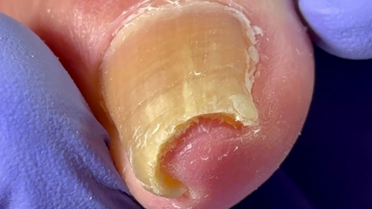 Super curly nails, crazy ingrown nails【Doctor Liu Pedicure】 - YouTube