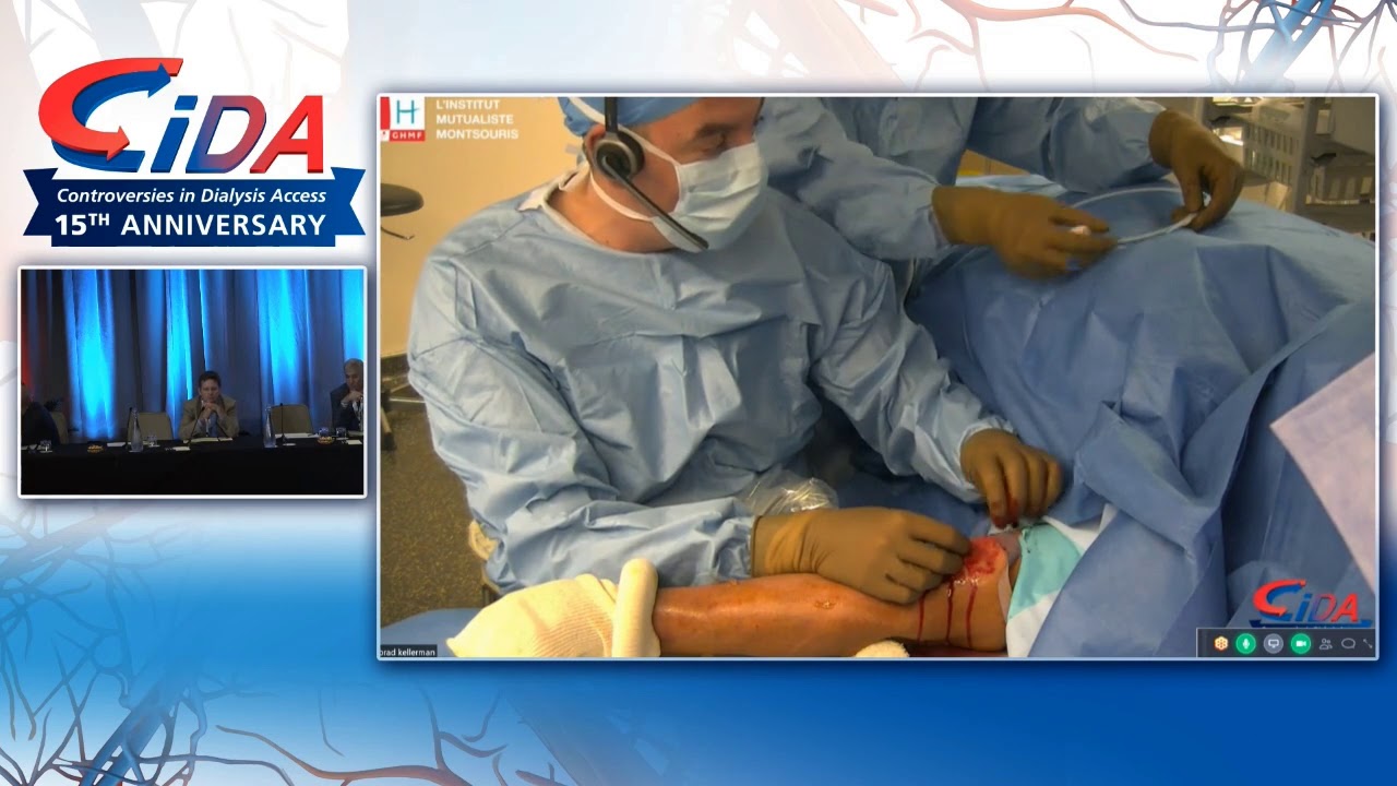 CiDA 2018 Ellipsys® Live Procedure - YouTube