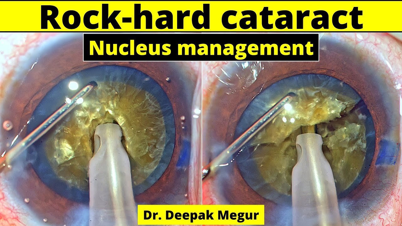 Brown rock hard cataract , Nucleus management - Dr. Deepak Megur - YouTube