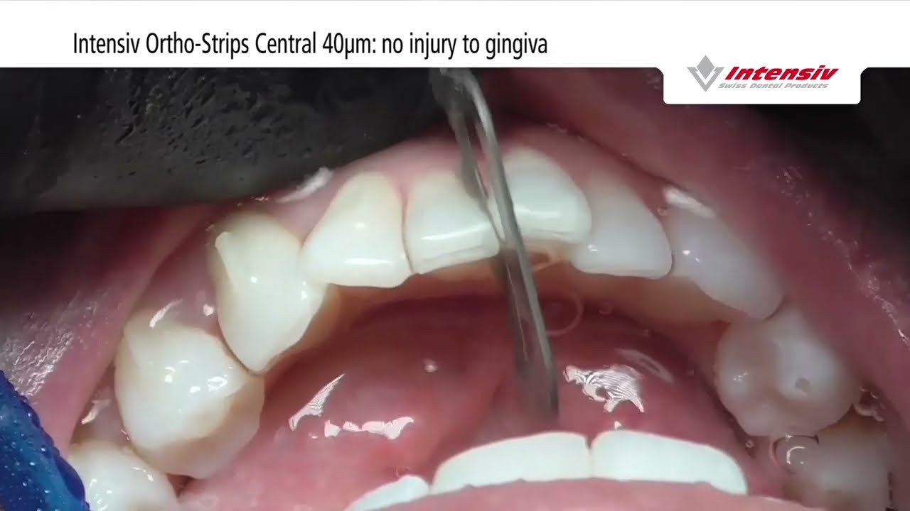 Intensiv Ortho-Strips System, Central - YouTube