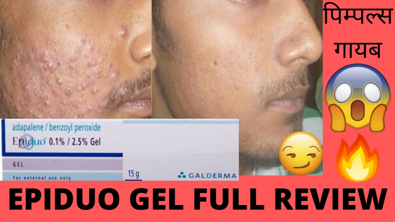 Epiduo Gel Full review Effects and Side Effects Best for Acne and ...