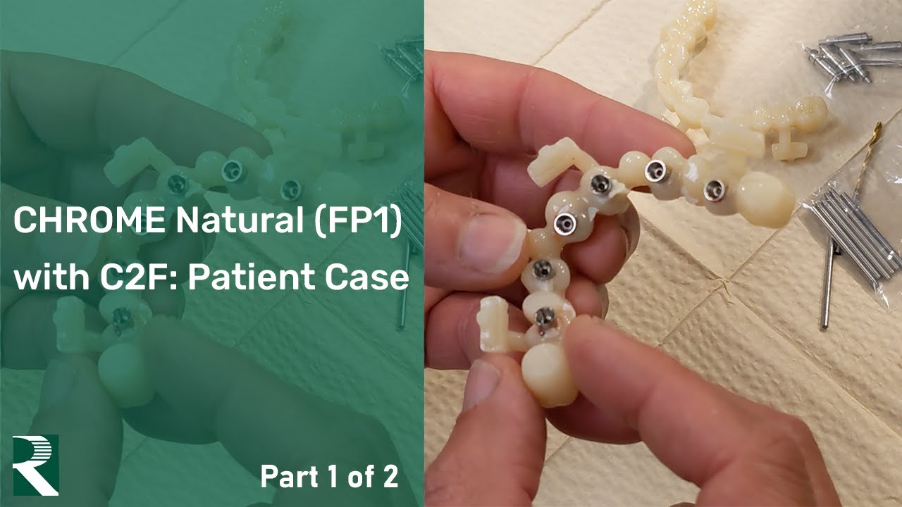 CHROME Natural (FP1) with C2F: Patient Case (Part 1 of 2) - YouTube