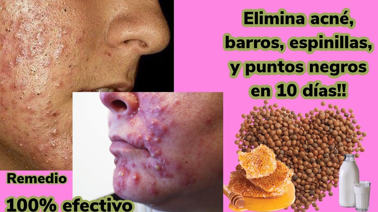 Como eliminar acne, espinillas, barros, y puntos negros en 10 días ...