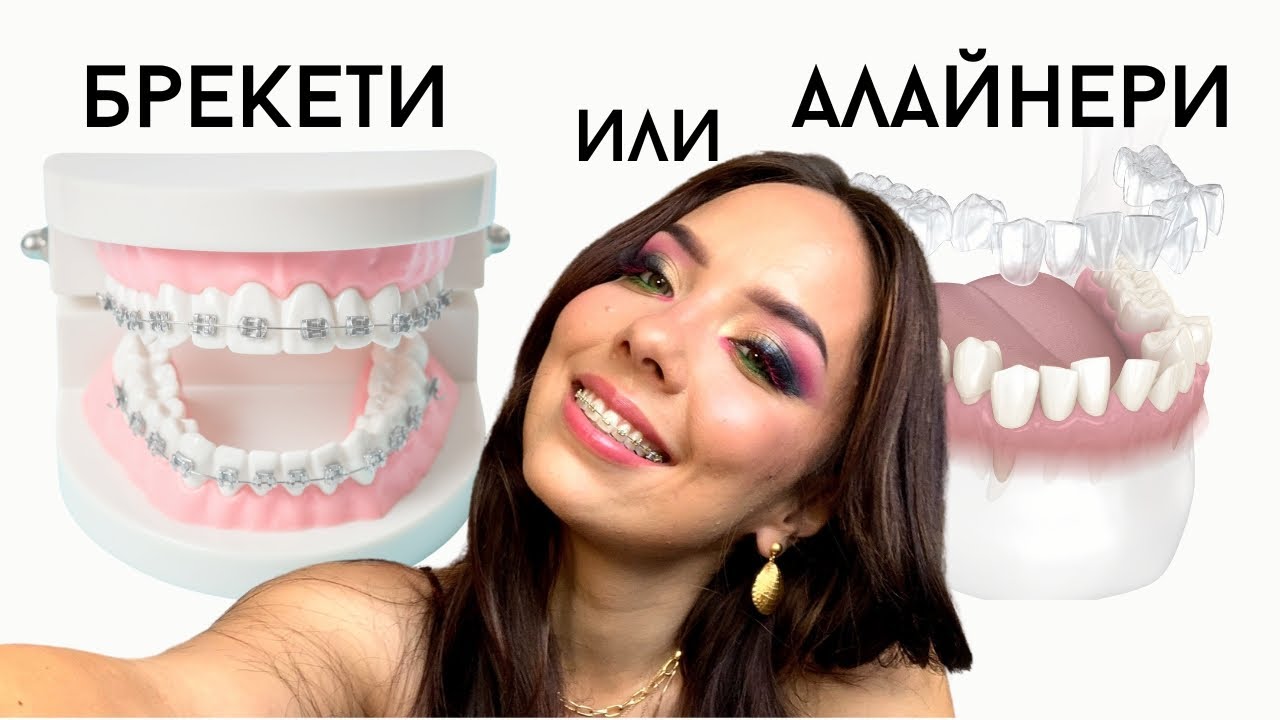 БРЕКЕТИ или АЛАЙНЕРИ ★ моят опит Youtube