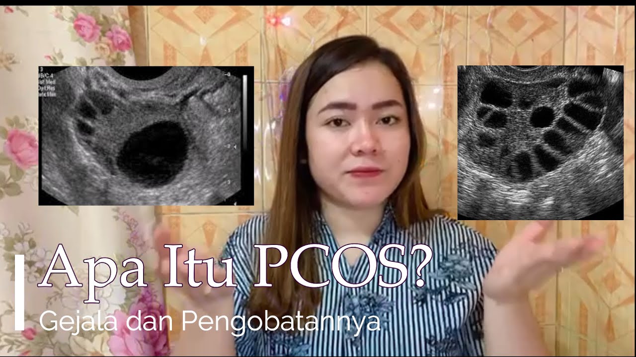 Apa Itu Pcos Dan Ciri Cirinya at Suzanne Prince blog