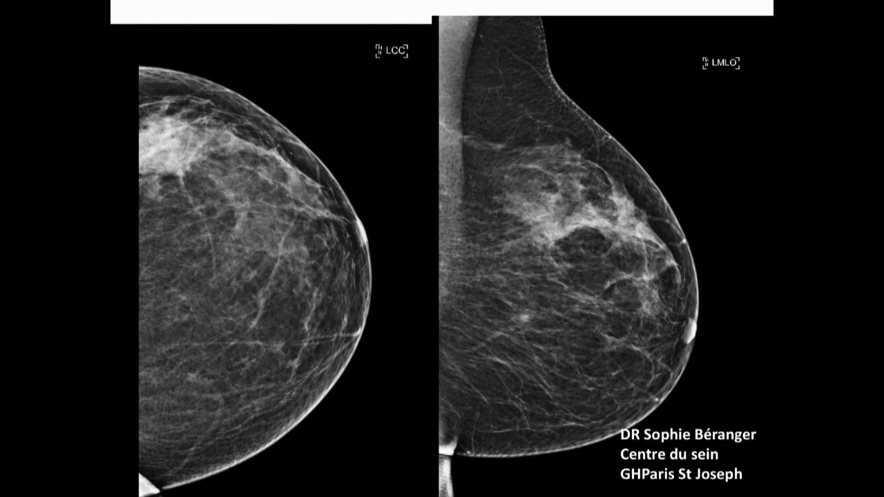 Cancer du sein - YouTube