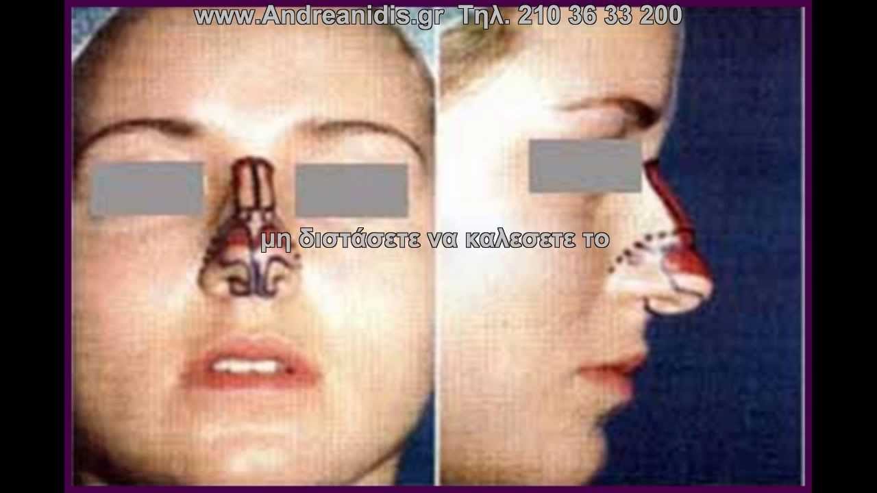 Ρινοπλαστικη με λειζερ - Ρινοπλαστικη με Laser - YouTube