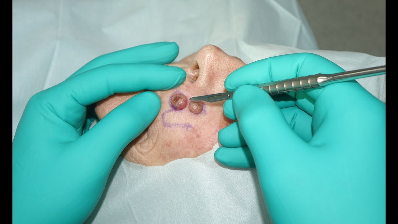 Kako odjednom ukloniti dva velika tumora na licu / How to remove two ...