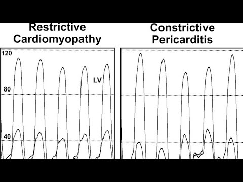 Restrictive cmp vs Constrictive Pericarditis - YouTube