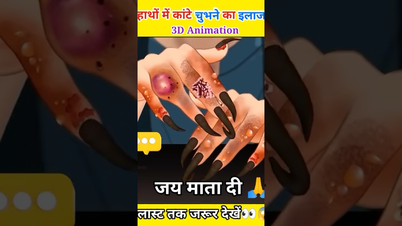 😱हाथों में कांटे चुभ जाएं तो क्या करें🤔, 3D animation_ hands treatment asmr @CrazyXYZ #shorts ...