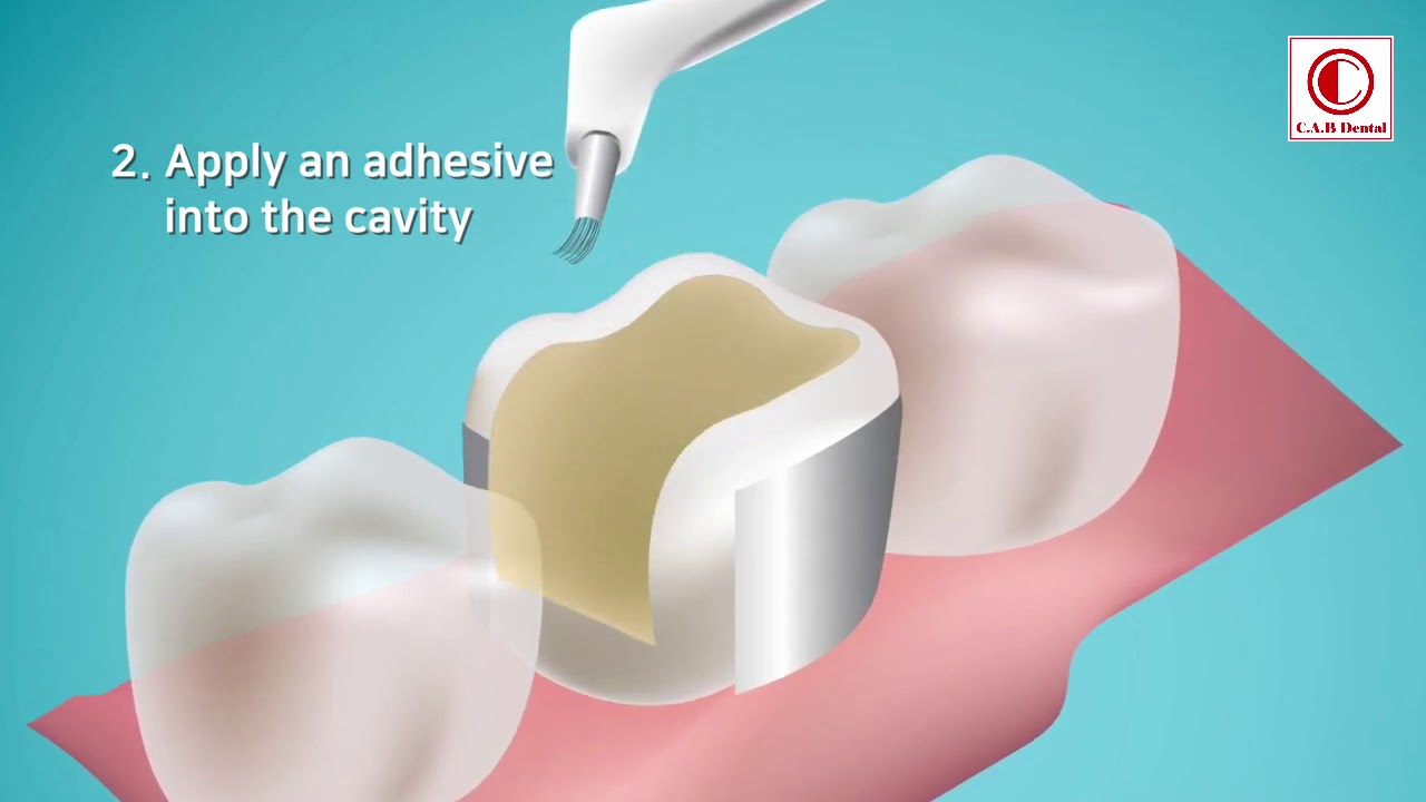 Vericom Denfil Bulk Flow - YouTube