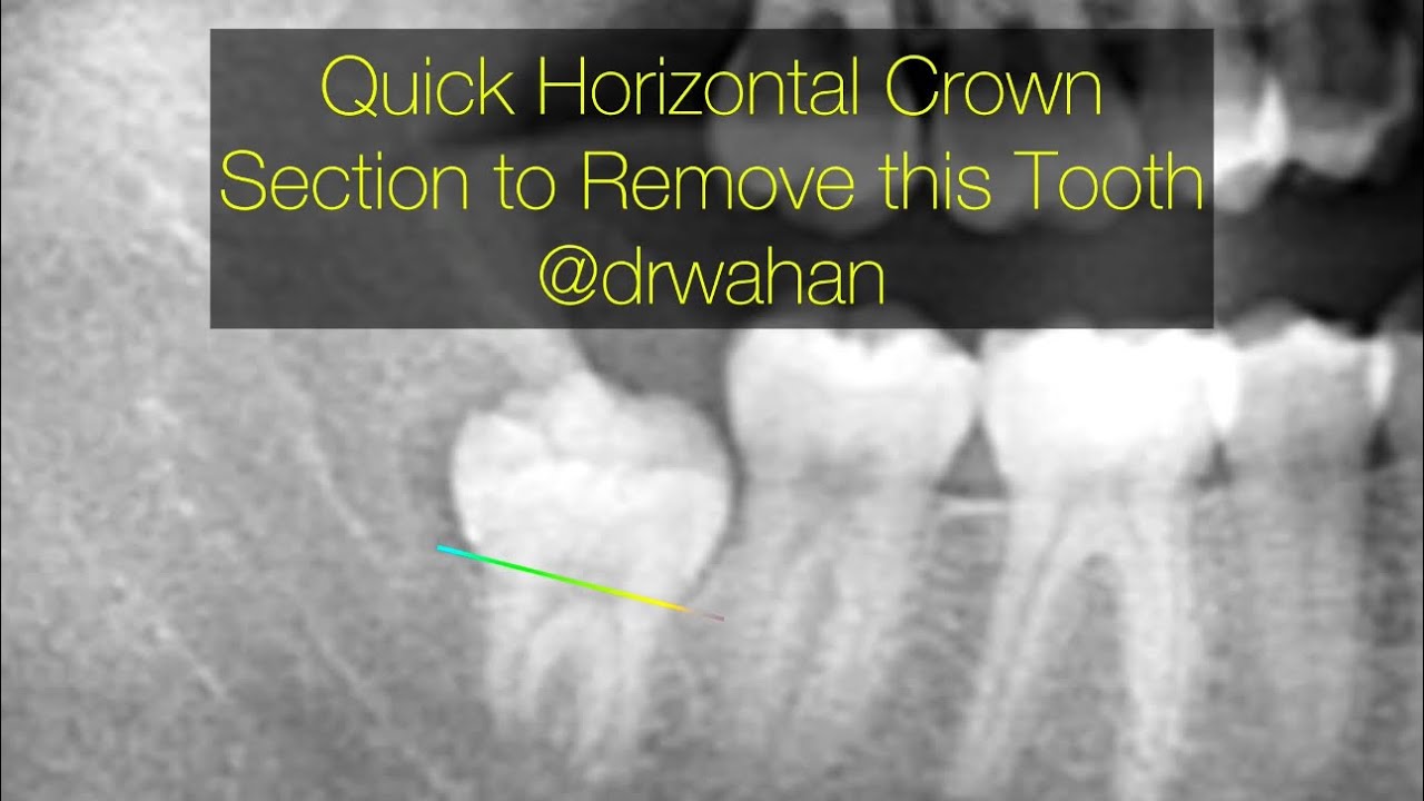 Cut the Crown off to Remove this Tooth @drwahan - YouTube