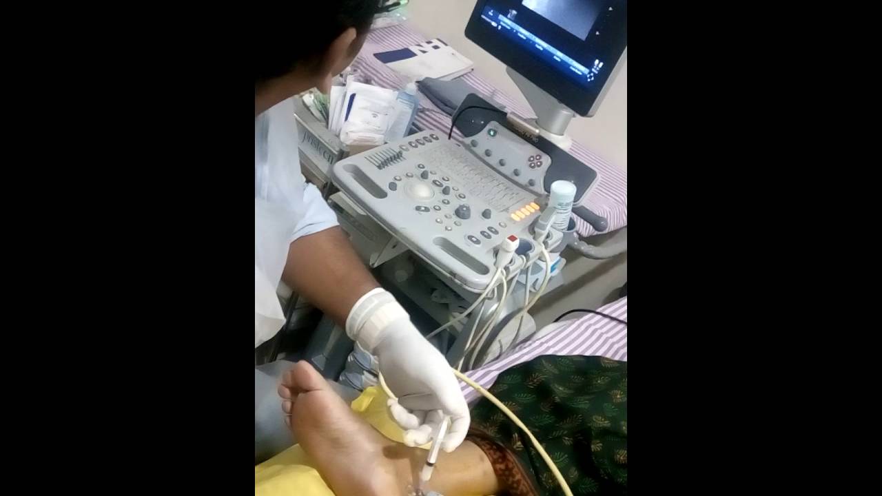 USG guided injection at Retrocalcaneal Bursa - YouTube