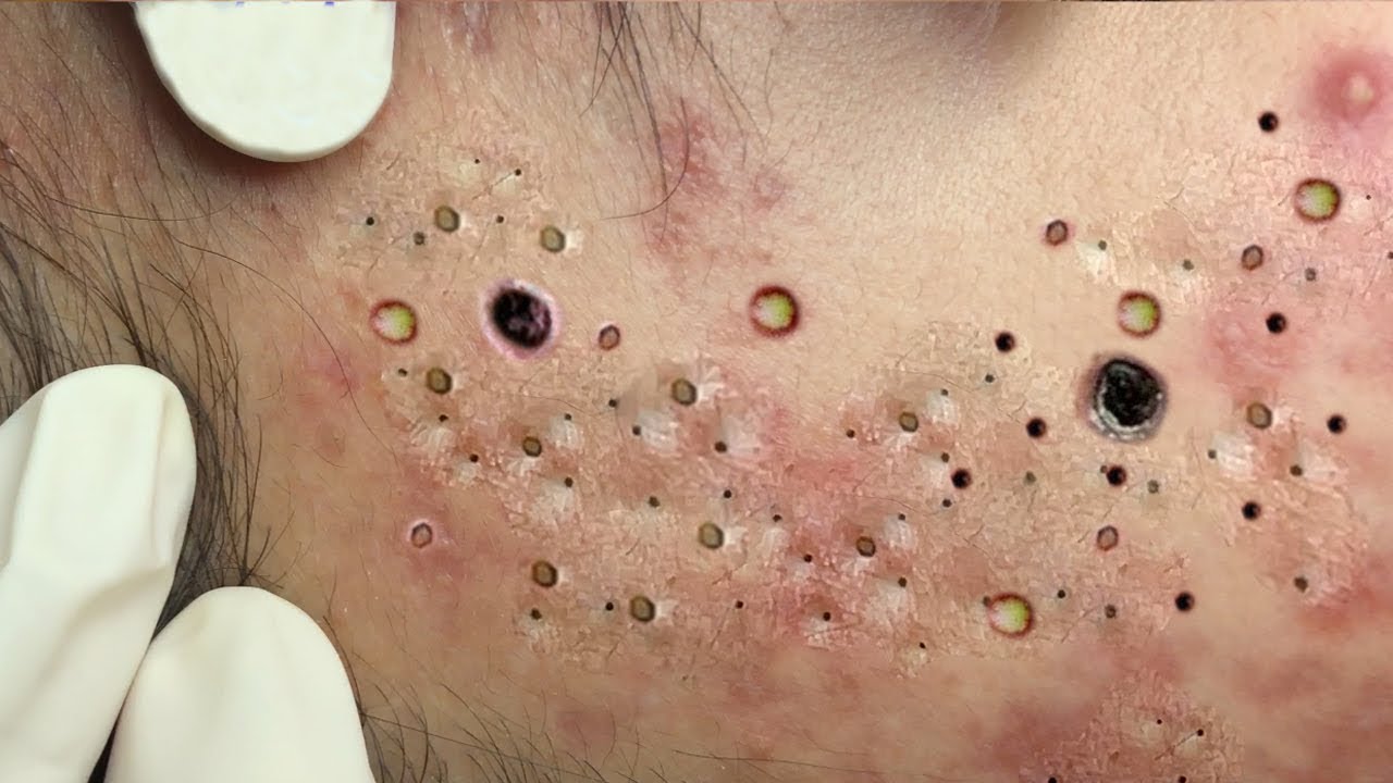 Make your Acne Treatment | Acne spa 27 | spa treatment - YouTube