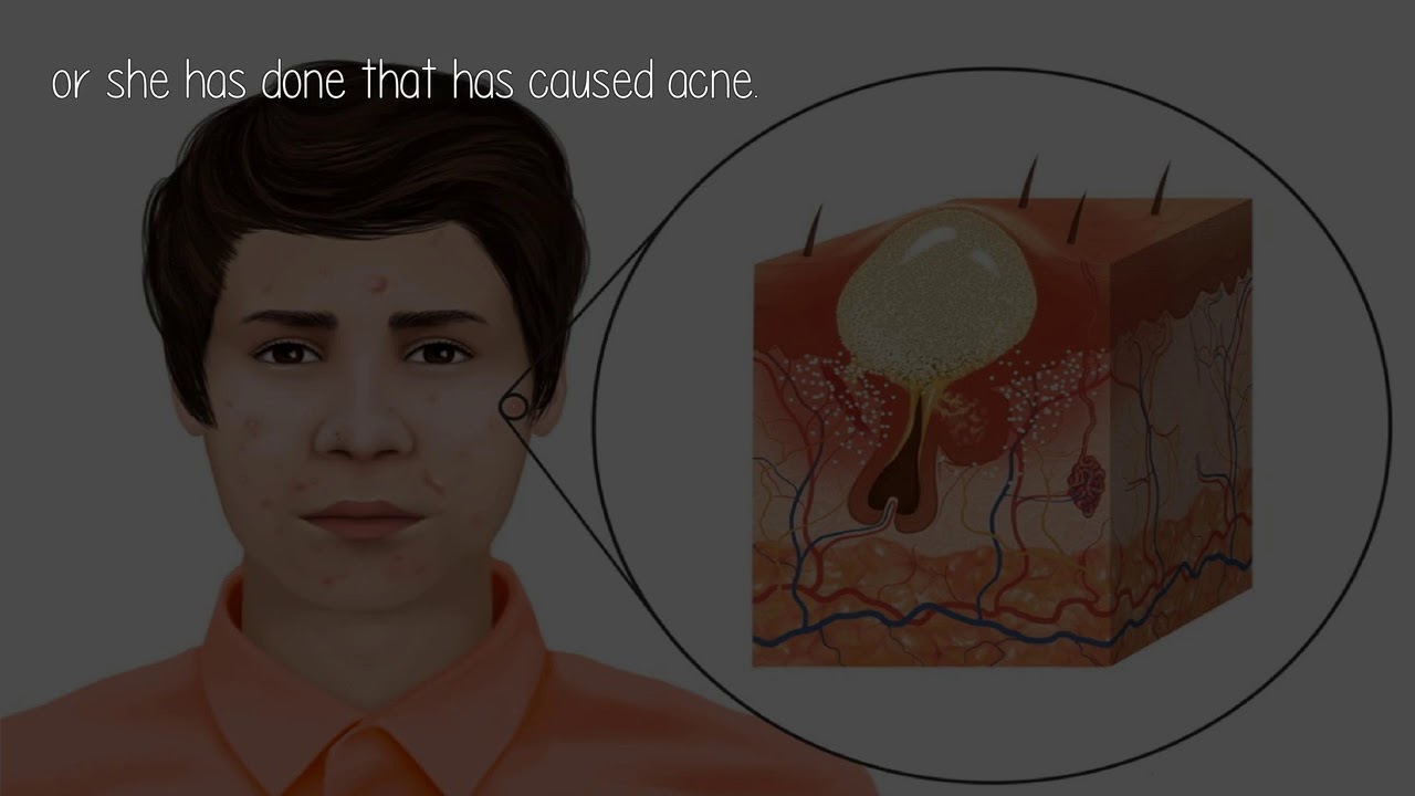 why-do-adults-get-acne-youtube