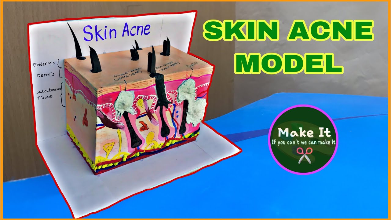 Skin Acne model | Skin Acne best model for school project | Pathology ...