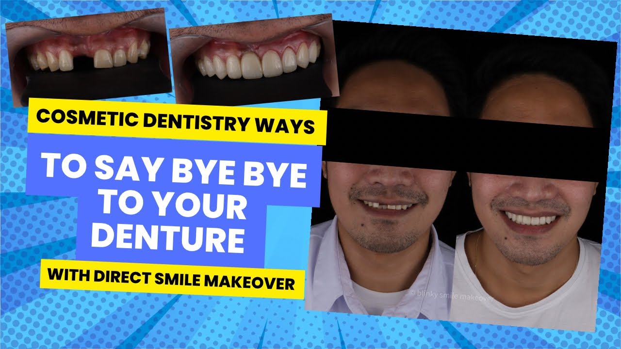 Missing tooth no more #veneers #smilemakeover - YouTube