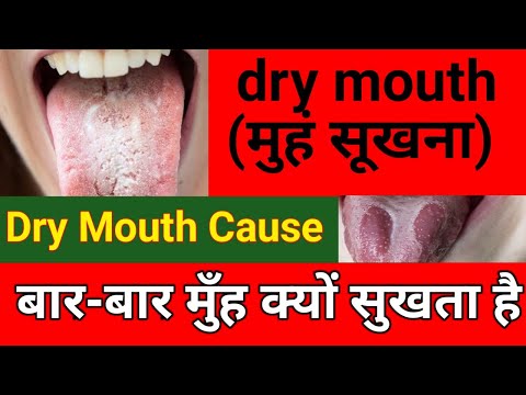 Dry Mouth.(मुंह सूखना) बार बार मुंह सूखने के कारण(Cause of dry mouth) | मुंह सूखना, dry mouth hindi