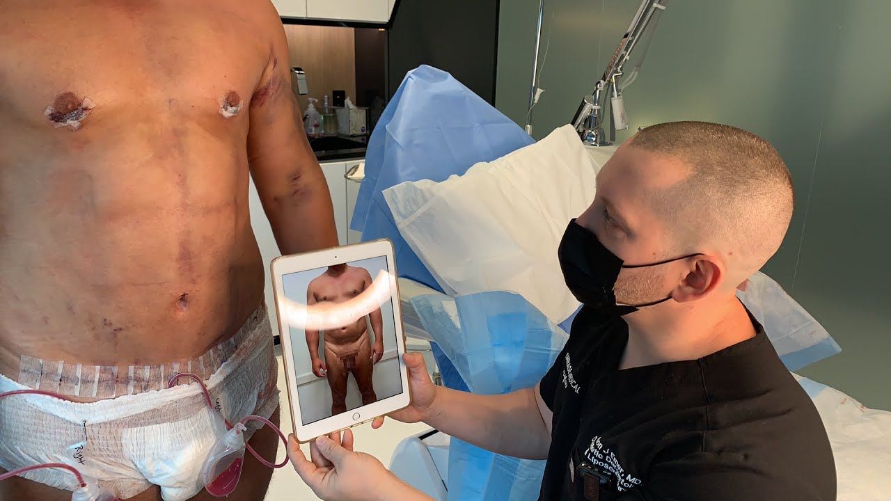 FIXING DAMAGED ABS AND SCAR TISSUE AFTER LIPOSUCTION WITH GLADIATOR ...