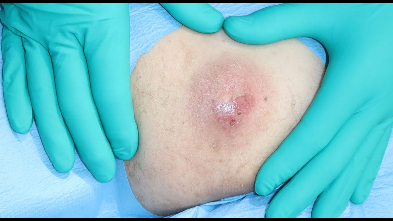 Drenaža gnojne upale stražnjice / Drainage abscess on the back - YouTube