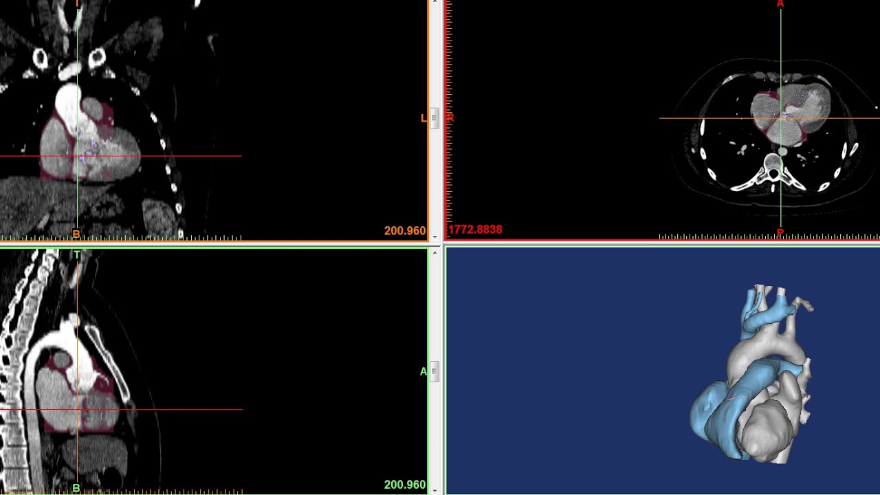 Case #24 : Subaortic Stenosis after CAVC Repair in Adult - YouTube