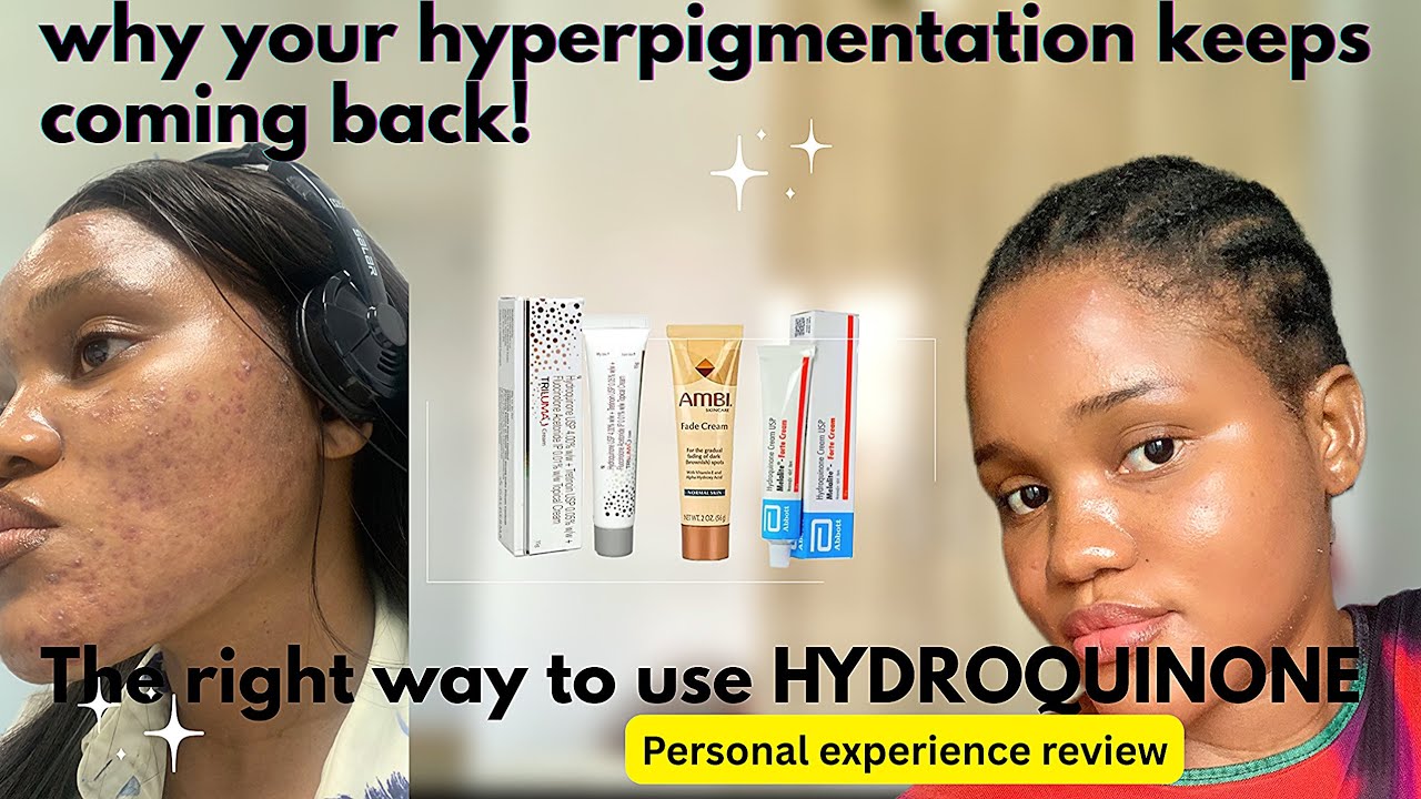 The Ultimate Guide to Using Hydroquinone for Hyperpigmentation 2025 ...