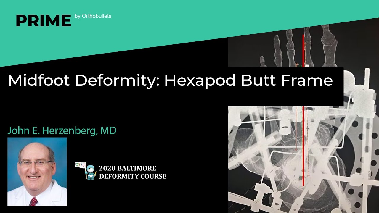 Midfoot Deformity: Hexapod Butt Frame - John E. Herzenberg, MD - YouTube