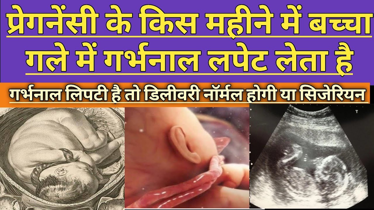Pregnancy ke kis mahine me baccha gale me Umbilical cord(Garbh Naal ...